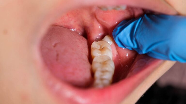 Agujero en la encía detrás de la última muela: causas y soluciones