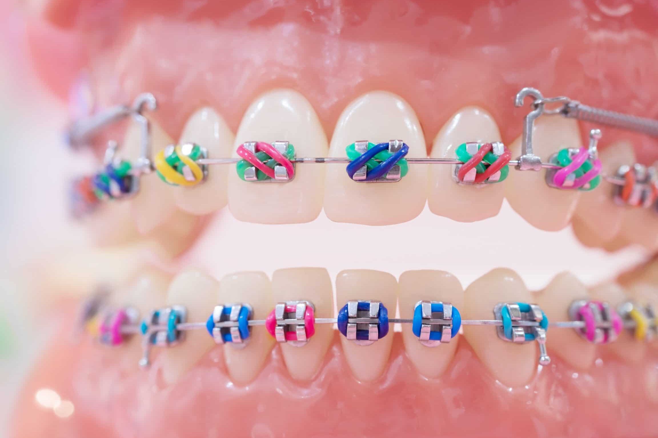 ¿Cuánto tiempo se deben llevar las gomas en los brackets?