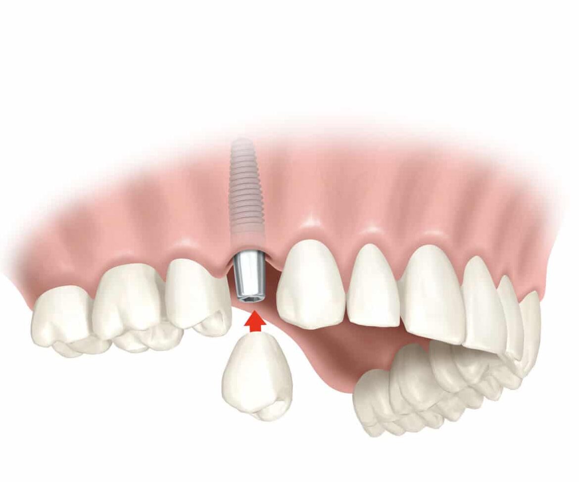 Sacar muela y poner implante en un día: todo lo que necesitas saber