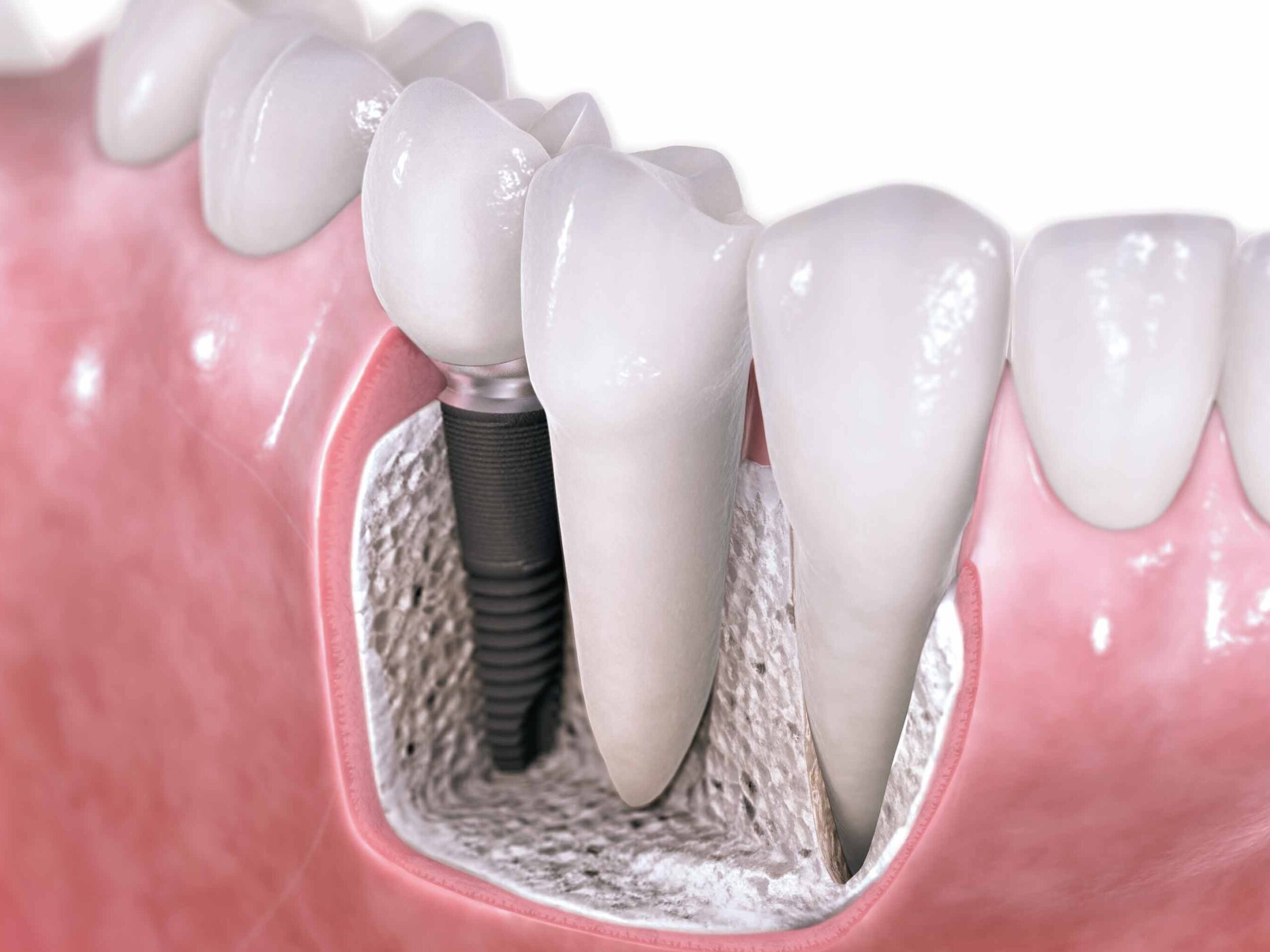 Descubre cuánto cuesta poner implantes en toda la boca y recupera tu ...