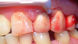 ¿Qué hacer si se te parte una muela? Consejos y soluciones