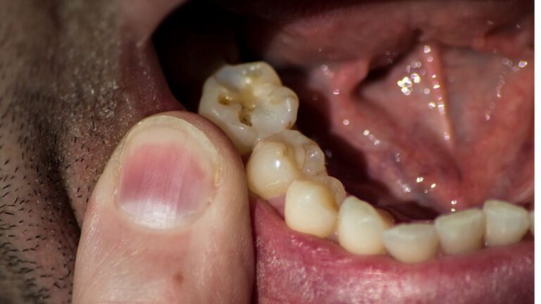 ¿Cómo salvar una muela que se mueve? Descubre la solución aquí