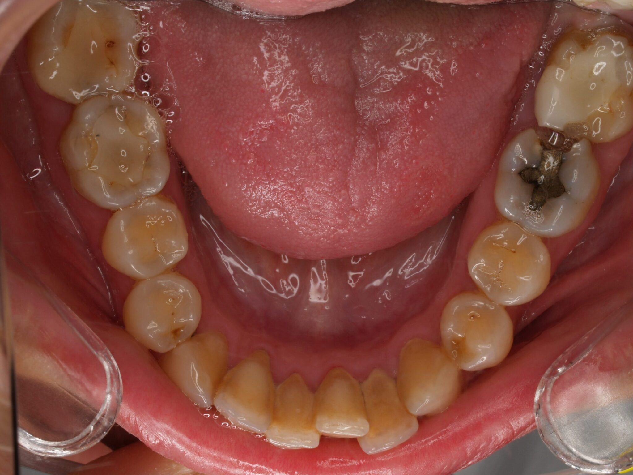 ¿Qué hacer si se te ha roto una muela con endodoncia?