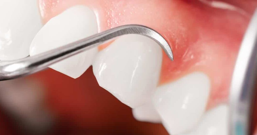 Muela rota al ras de la encía: ¿qué hacer para evitar el dolor?