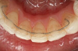 Descubre la función del paladar dental y por qué es tan importante para ...